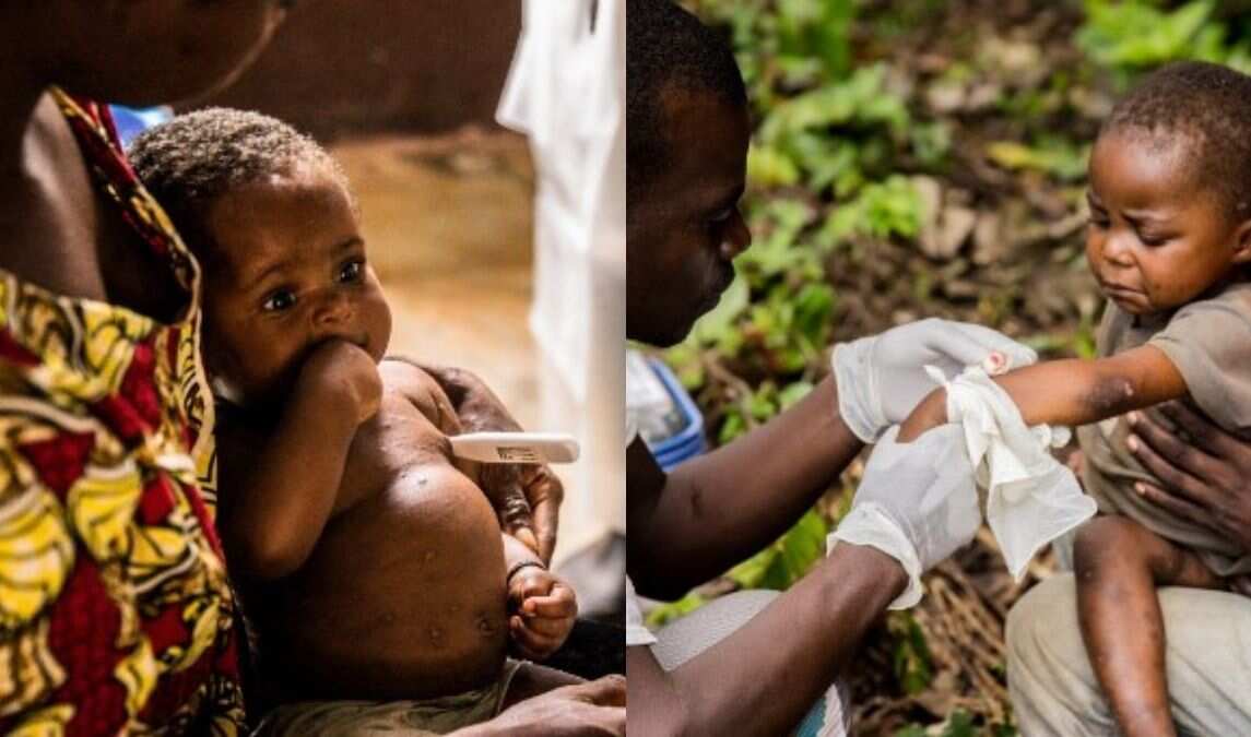 Explained: What is Monkeypox? Its causes, symptoms and treatment ...