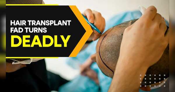 Seemingly harmless hair transplant turns fatally wrong for India's Athar Rasheed - Edge News
