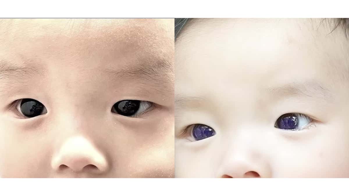 Infant s Eye Colour Changes From Dark Brown To Bright Blue After COVID infant-s-eye-colour-changes-from-dark-brown-to-bright-blue-after-covid
