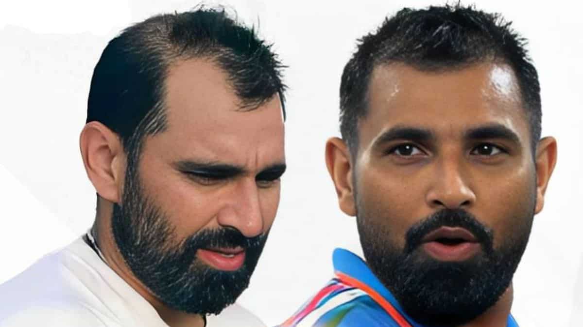 Celebrity hair transplant surgeons reveal the secret behind Mohammed ...