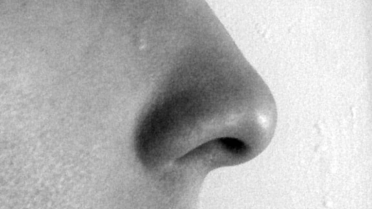 Doctors remove 150 live bugs from man's nose in Florida - World News