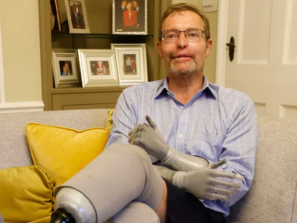 Tory MP Craig Mackinlay was amputated due to sepsis. Know all about ...