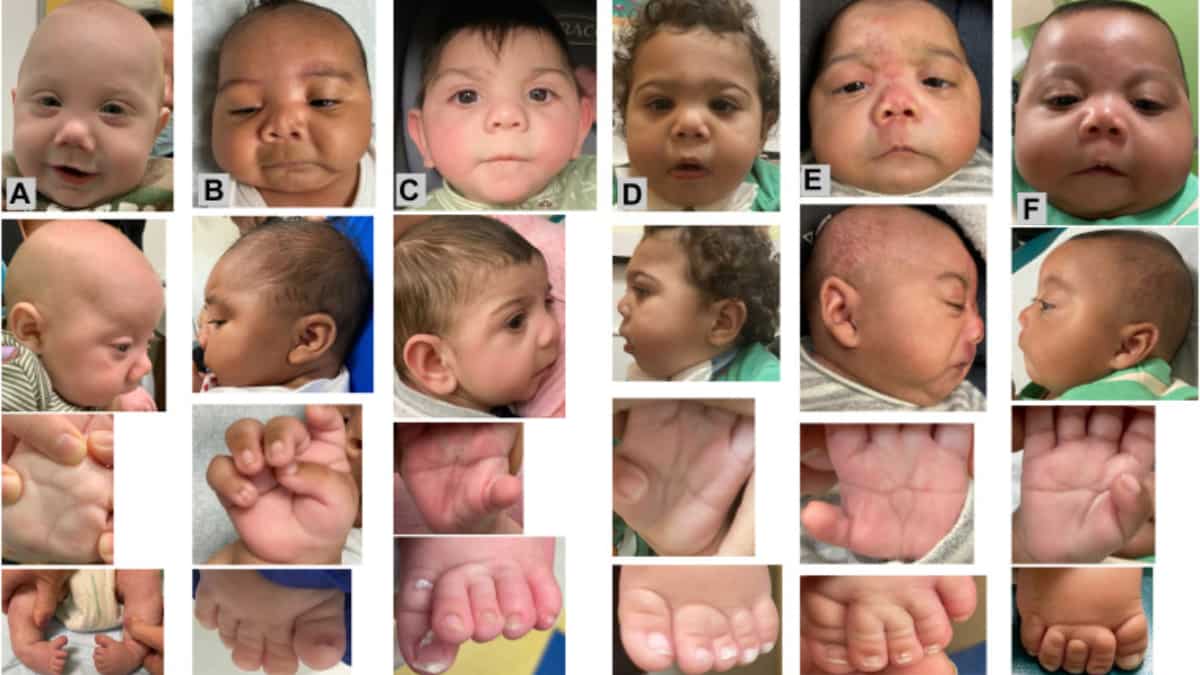 Cleft palate, fused toes: Fentanyl likely causing certain birth defects ...