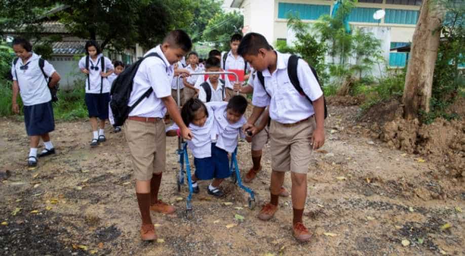 Conjoined Thai twin sisters Pin and Pan say they don't want to be ...