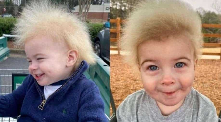 Locklan Samples: This boy suffering from 'uncombable hair syndrome' has ...