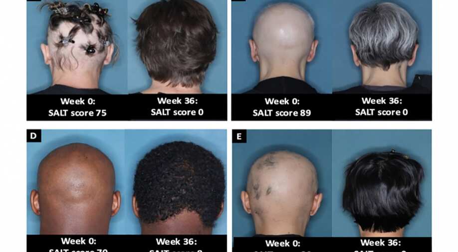 US FDA approves first oral tablet called baricitinib for treatment of ...