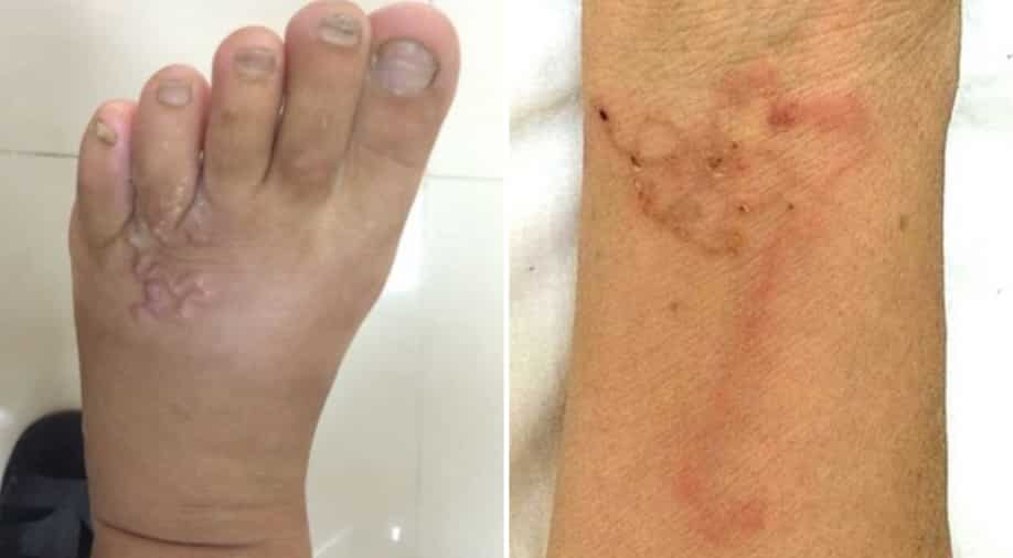 Vietnamese woman found worms crawling under skin after consuming blood ...