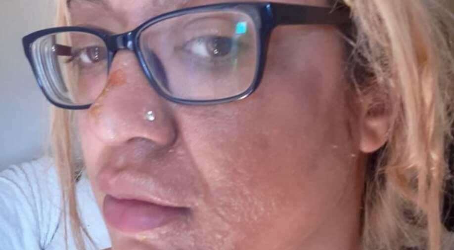 Shocking: Woman's face peels off in horrifying accident while trying ...