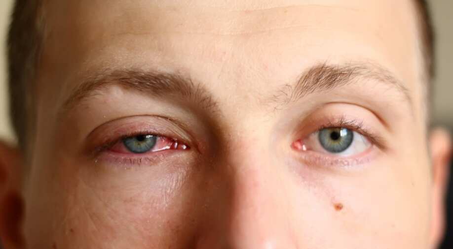 India sees spike in conjunctivitis: What is pink eye? Check symptoms ...