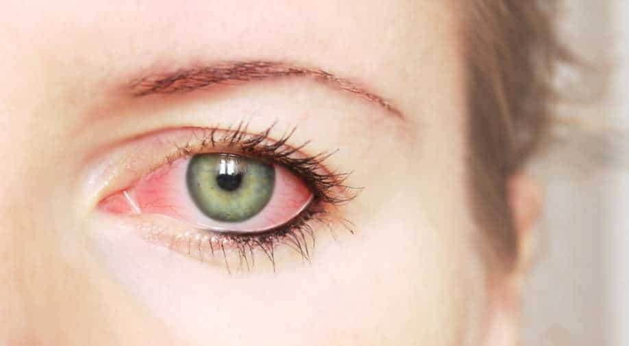 One man infects 5 women with rare eye syphilis following sexual ...