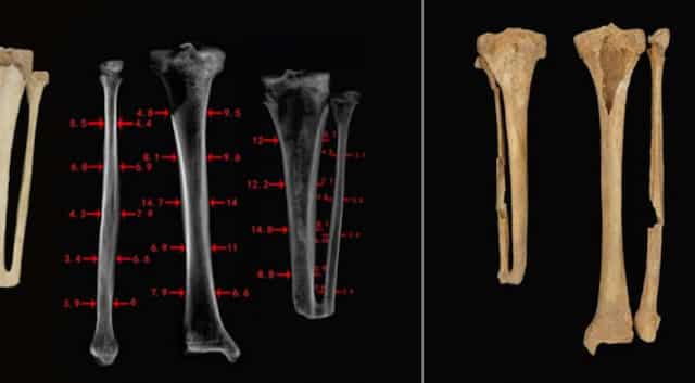 Ancient justice: Chinese skeletons reveal limb amputation as punishment ...